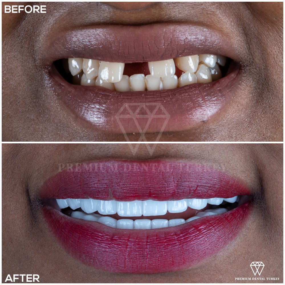 Veneers Turkey - Prices for Full Set of Emax & Zirconium Porcelain Veneers