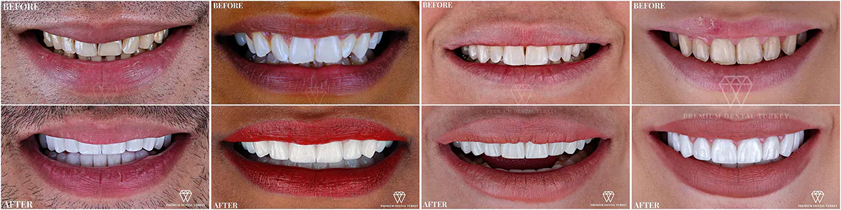 Veneers Turkey - Full Set of Veneers in Turkey Prices, Advantages