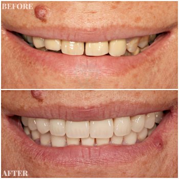 Turkey Teeth : Everything you need to know before getting your teeth ...