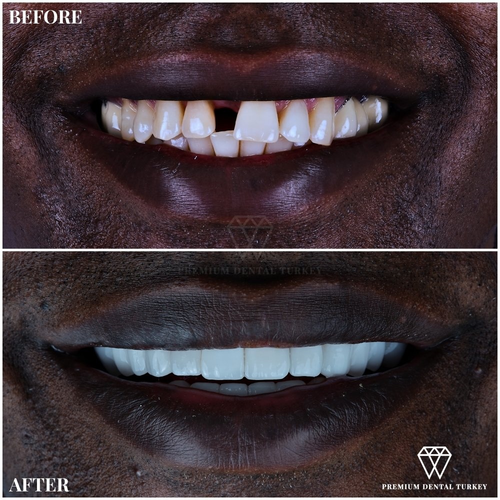 Turkey Teeth : Everything you need to know before getting your teeth ...